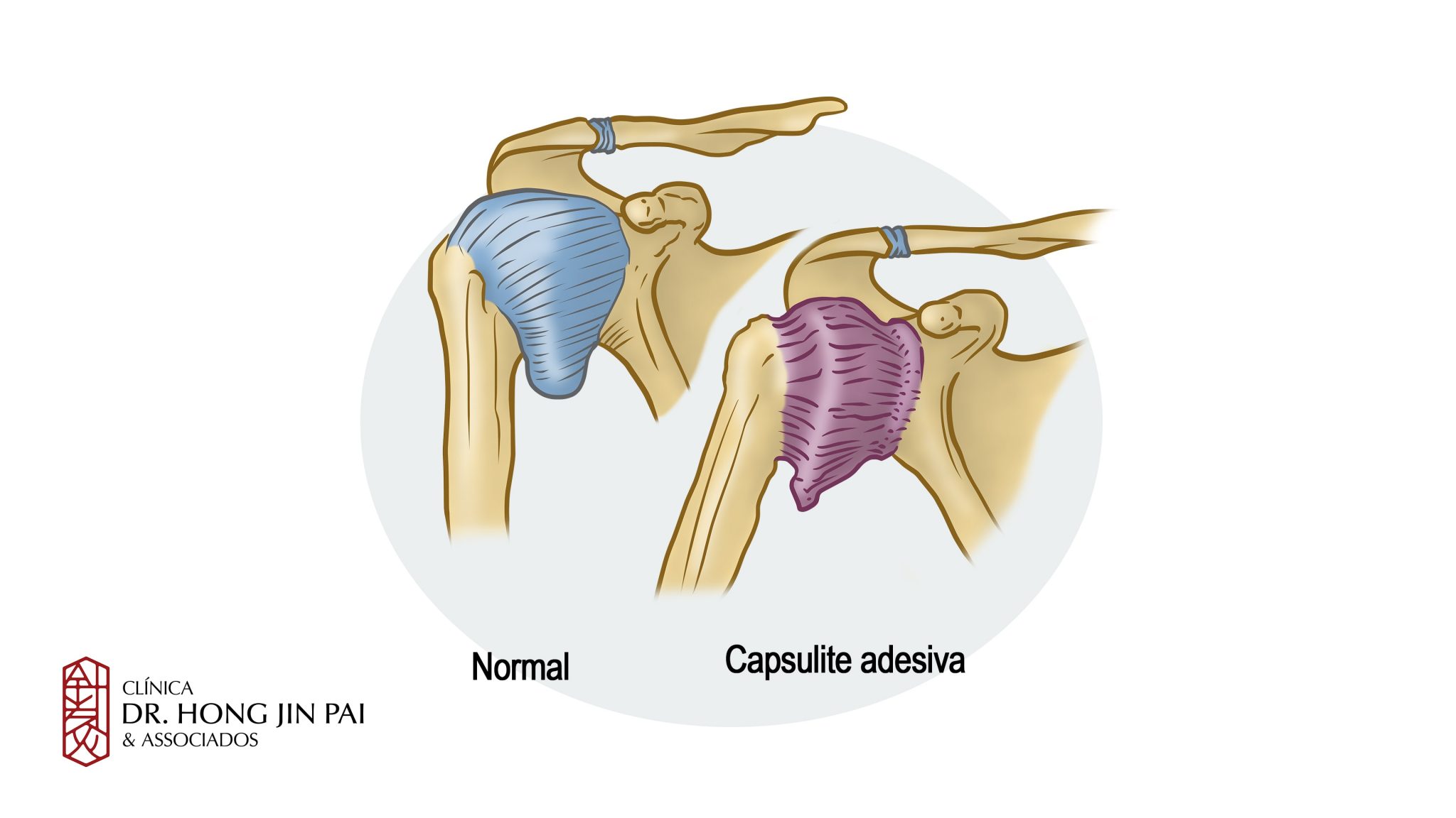O que é capsulite adesiva? - Ceimec